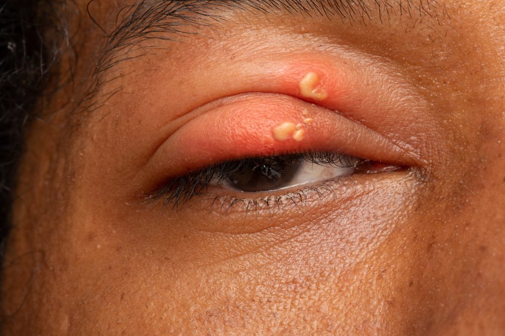 Protect yourself from Shingles - get vaccinated! - BetterMyMeds